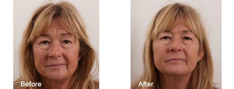 Skin Tightening | Twin Care Family Clinic